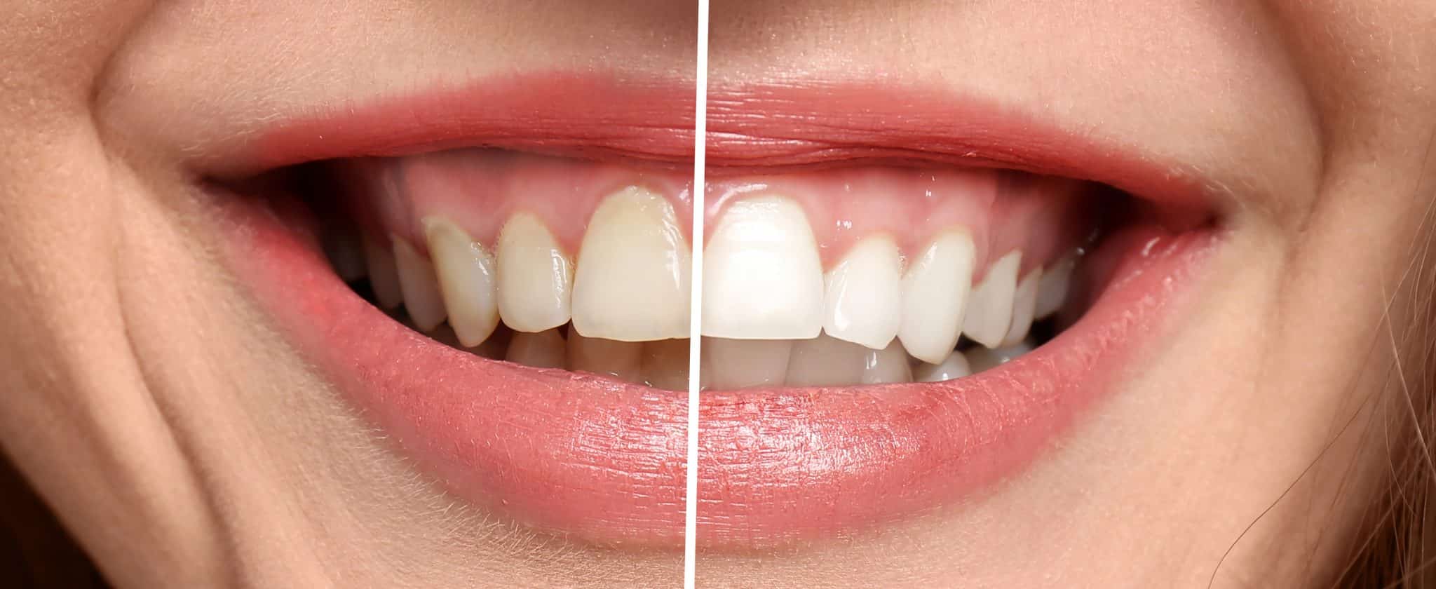 The Benefits of Tooth Reshaping and Contouring in Mission Valley