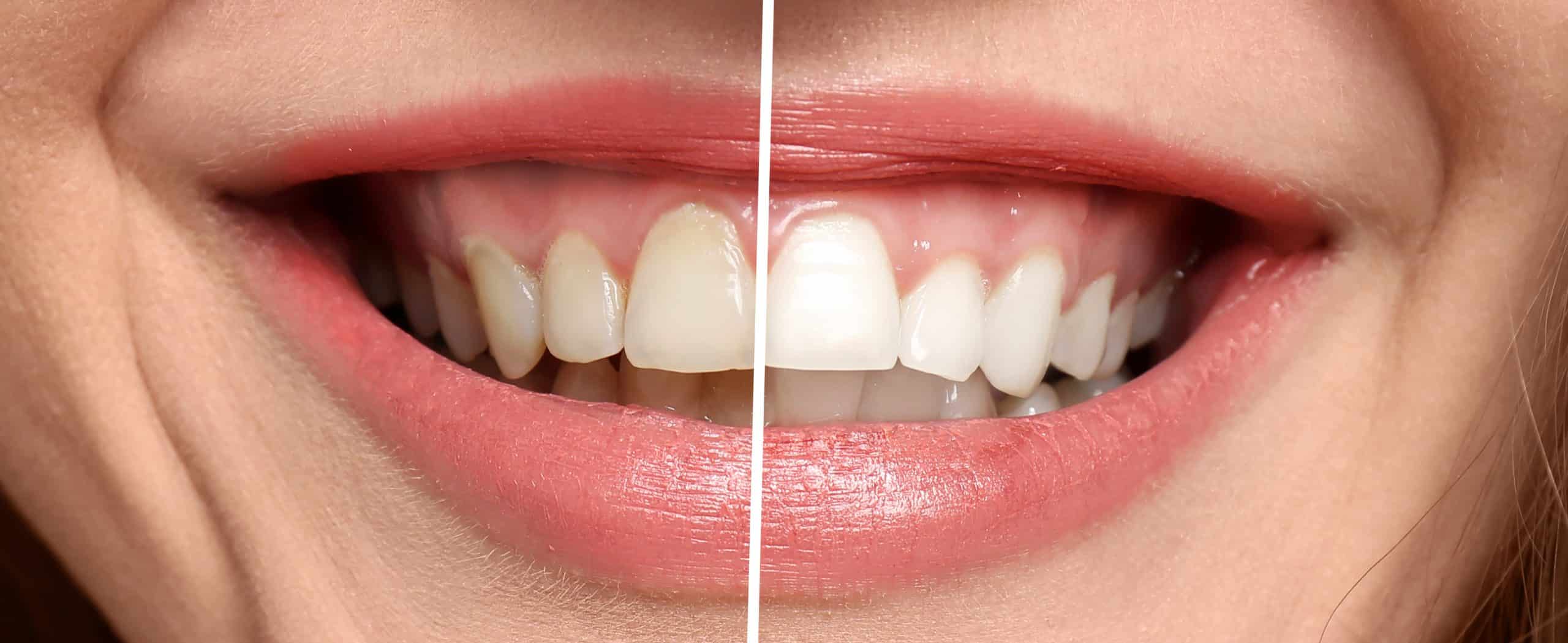 The Benefits of Tooth Reshaping and Contouring in Mission Valley